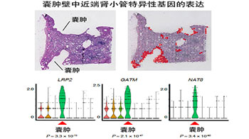Cáncer de Riñón: Mecanismo de Formación de Quistes Revelado – Notiulti